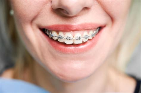 Brackets Met Licos En Madrid Control Dental Europeo