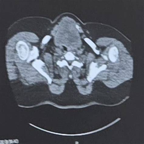 Large Thyroid Nodules On Us R Thyroidhealth