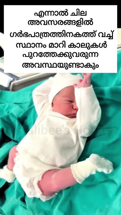 ജനിക്കുമ്പോൾ കുഞ്ഞിന്റെ കാലുകൾ ആദ്യം പുറത്തു വരുന്നത് Shorts Pregnancy Malayalam Trending