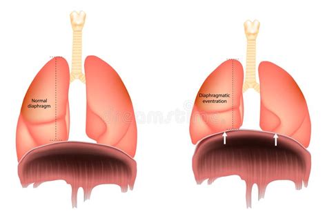 Hemidiaphragm Stock Illustrations 2 Hemidiaphragm Stock Illustrations
