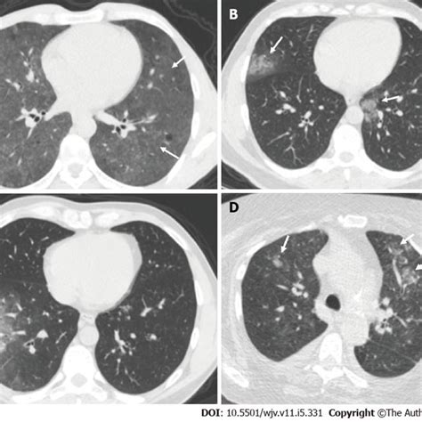A Thoracic Computed Tomography Scan In A 5 Year Old Female Patient Download Scientific Diagram