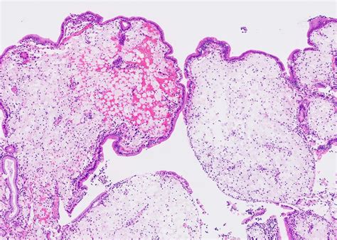Hyperplastic Polyp Pathology Outlines Clinical Pathology Intestinal
