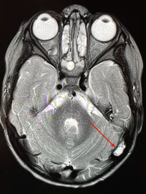 Spin Academics On Linkedin Tip Of The Day 💡 Arachnoid Granulation Tissue Nothing Else Was…
