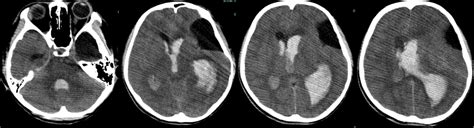 神经内镜下儿童脑血管畸形切除一例（脑血管系列三十三 ） 浙二神外周刊（第256期） 脑医汇