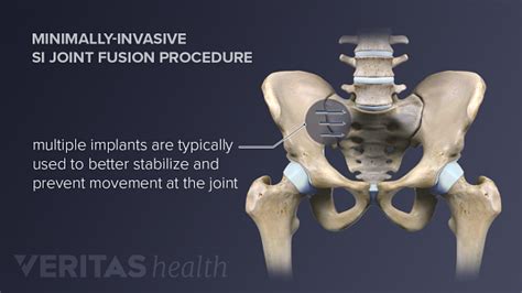 How Sacroiliac Joint Fusion Is Performed