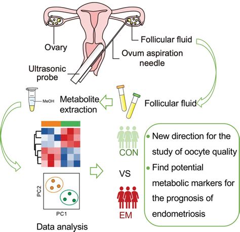 Nontargeted Metabolomics Analysis Of Follicular Fluid In Patients With Endometriosis Provides A