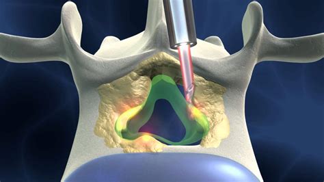 Endoscopic Decompression Spinal Canal At Gail Cook Blog