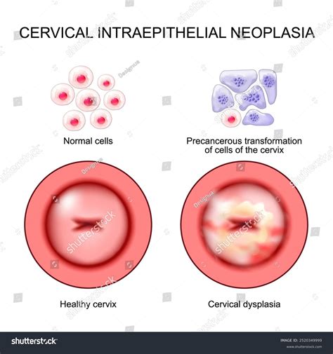 Pre Cancerous Cervical Cells