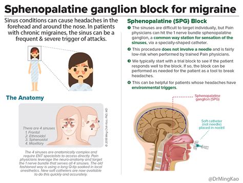 Sphenopalatine Ganglion Block