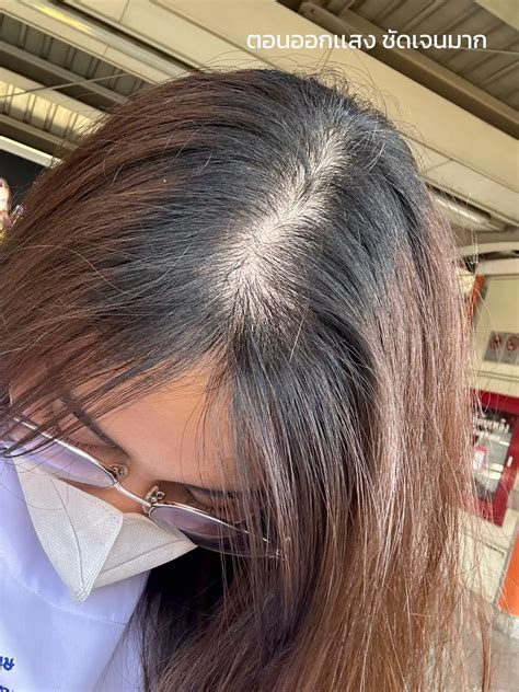 ประสบการณ์ผมร่วงวัย 20 ต้นๆ🙂‍↕️ แกลเลอรีที่โพสต์โดย Ploychompoo🫧 Lemon8