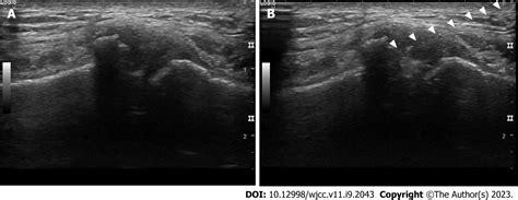 Costochondritis Injection Ultrasound At Joseph Starr Blog
