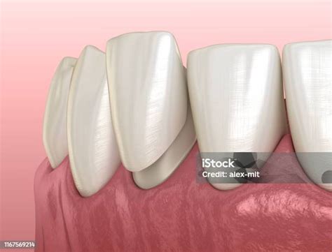 측면 절개를 통해 하악 베니어 설치 절차 의학적으로 정확한 치아 3d 일러스트레이션 유대감에 대한 스톡 사진 및 기타 이미지 유대감 이빨 치아 베니어 Istock