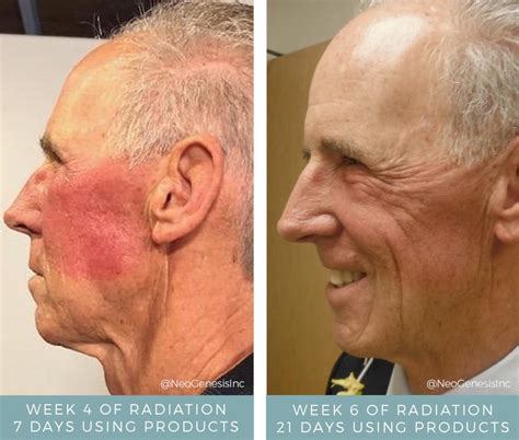Radiation Dermatitis Squamous Cell Carcinoma Before After