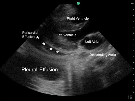 Left Pleural Effusion