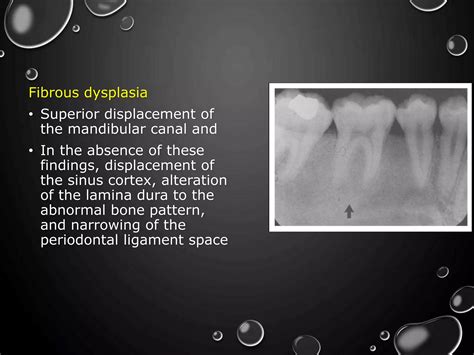 Osteomyelitis PPTX Bone And Joint Conditions Diseases And Conditions