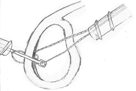 The Oblique Mattress Lasso Loop Stitch For Arthroscopic Capsulolabral Repair Arthroscopy