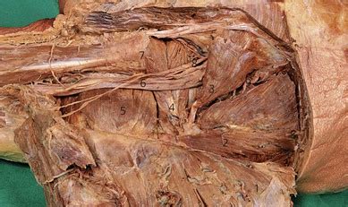 Posterior Sciatic Block Anesthesia Key