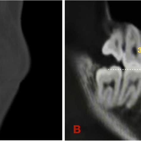 Angular Measurements Of Right First Molars On The Sagittal Ct Image Download Scientific
