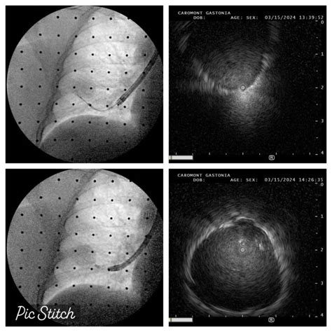 Biopsying Pulmonary Nodules Masses Medtronic Illumisite Bronchoscopy Masses Lesions