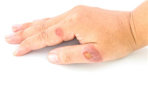 Pyoderma Gangrenosum