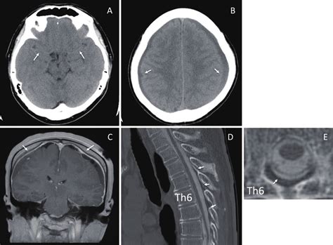 A B Initial Brain Ct Scan Shows Bilateral Csdh And Pseudo Sah C Download Scientific Diagram