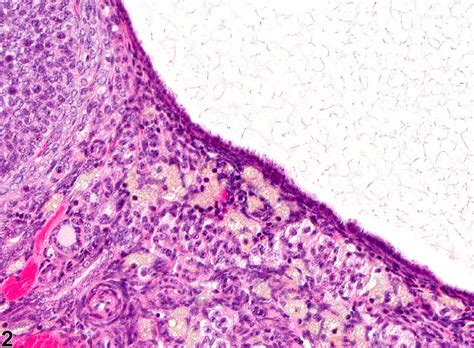 Ovarian Cyst Histology Ovary Cyst Epithelial Nonneoplastic Lesion