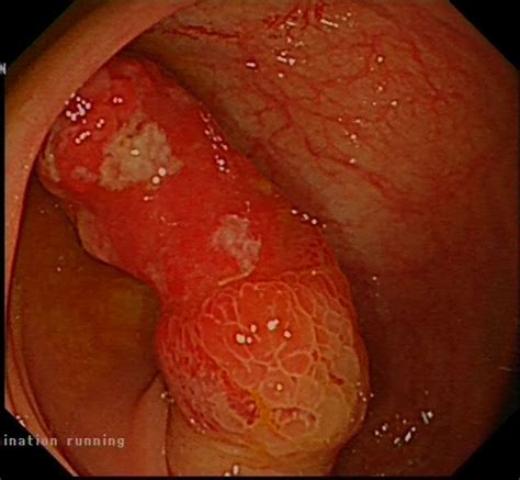Caecal Polyp Inverted Appendix With Wide Ulceration Download