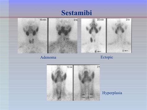 Endoscopic Parathyroid Surgery