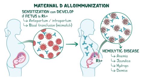Maternal D Alloimmunization Management Clinical Sciences Osmosis Video Library