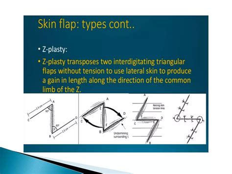 Flap And Its Classification Pptx