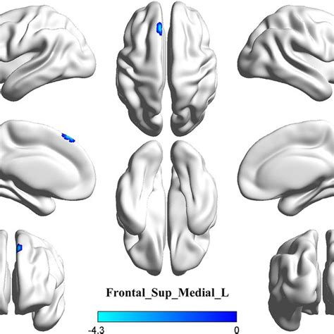 Activated Brain Regions Showed By Rs Fmri Using Method Of Alff In Mdd
