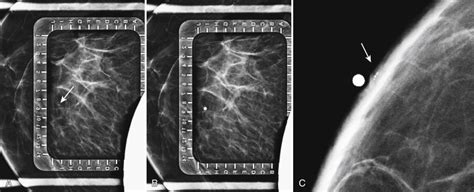 Mammographic Analysis Of Breast Calcifications Clinical Tree