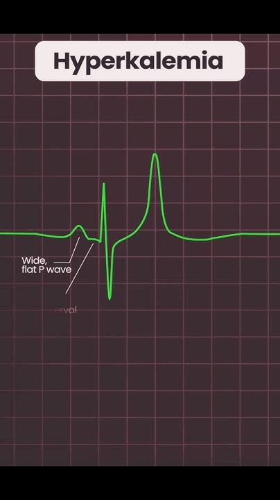 Hyperkalemia Vs Hypokalemia Ecg Of Heart Shortsfeed Ecg Ecginterpretation Shorts Youtube