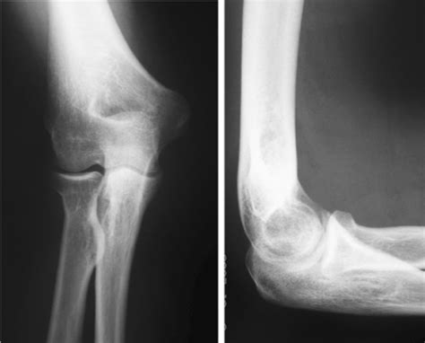 Olecranon Fossa X Ray
