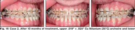 Nonsurgical Correction Of Severe Skeletal Class Iii Malocclusion Semantic Scholar