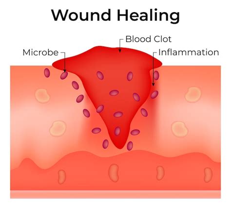 Premium Vector Wound Healing Microbe Blood Clot Inflammation Vector