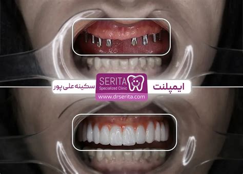 قیمت ایمپلنت کره ای به تفکیک برند و بررسی ایمپلنت کره ای