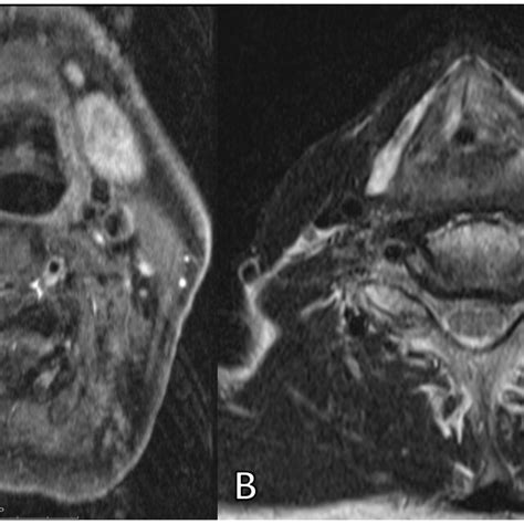 A False Positive Mri With Suspicious Ln Metastasis In Level Ii Download Scientific Diagram