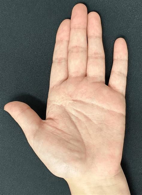 Removal Of Spindle Cell Hemangioma Rmedicalgore