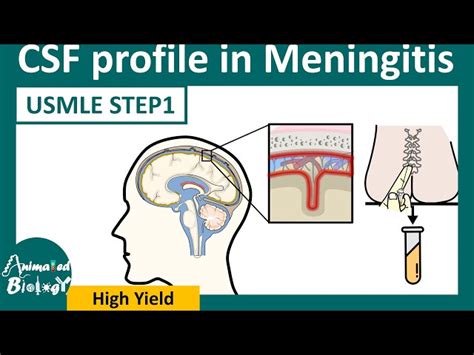 Meningitis In Csf Evaluation