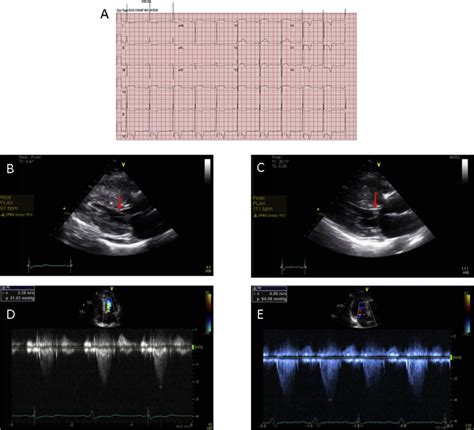 Provocable Lvot Obstruction With Exercise Stress Echocardiography A