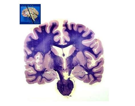 Diencéfalo E Telencéfalo Corte Frontal 3 Quiz