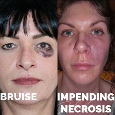 Causes Of Vascular Occlusion And Necrosis Dr Tim Pearce