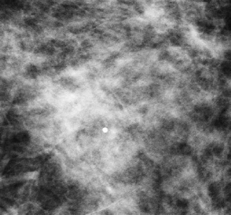 Patient 5 Single Round Calcification With Mass Calcification Pattern Download Scientific