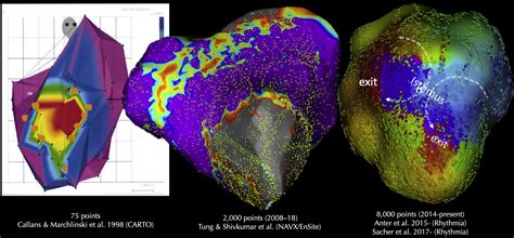 Substrate Mapping In Ventricular Arrhythmias Cardiac