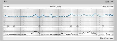 16 3 External And Internal Monitoring Medicine Libretexts