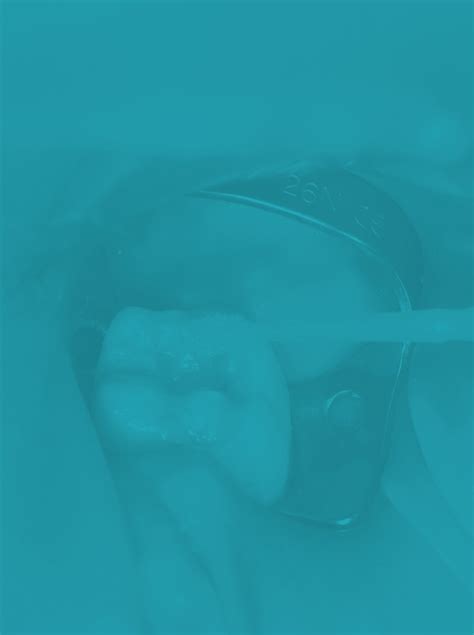 Fissure Sealing Pocket Dentistry