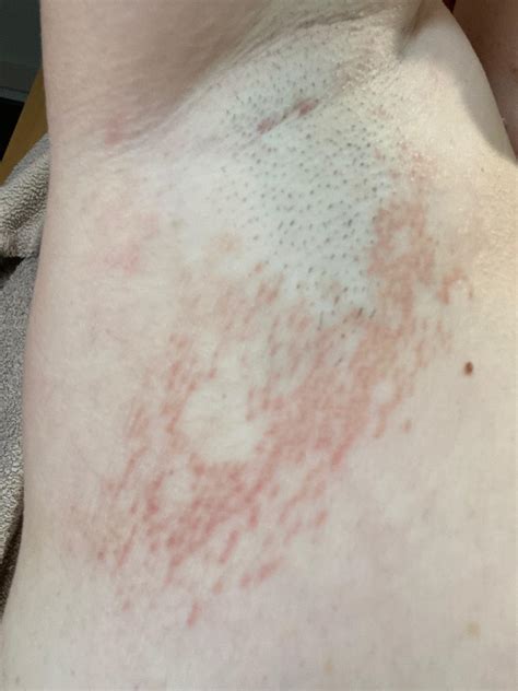 Rash below armpit : r/DermatologyQuestions