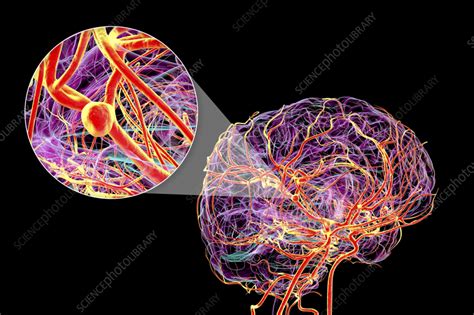 Saccular Brain Aneurysm Illustration Stock Image F0439828