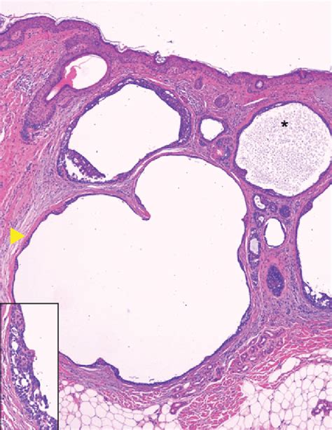Groups Of Peripheral Basaloid Cells With Hyporefractive Content Yellow